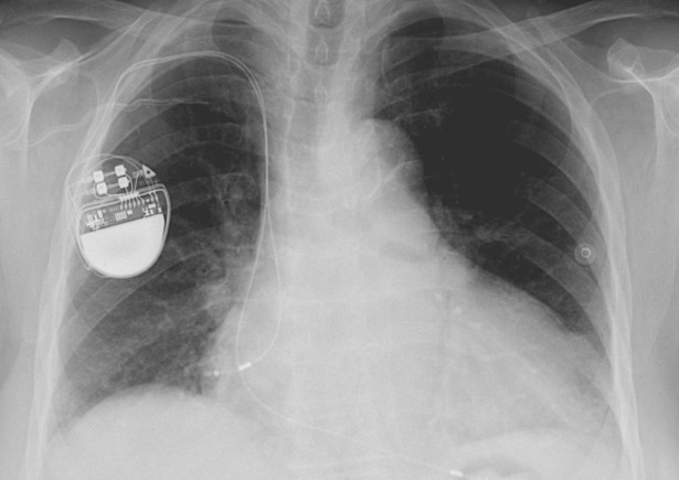 Who Killed the Rechargeable Pacemaker? - The Atlantic