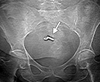 So You've Swallowed Your Dentures - The Atlantic