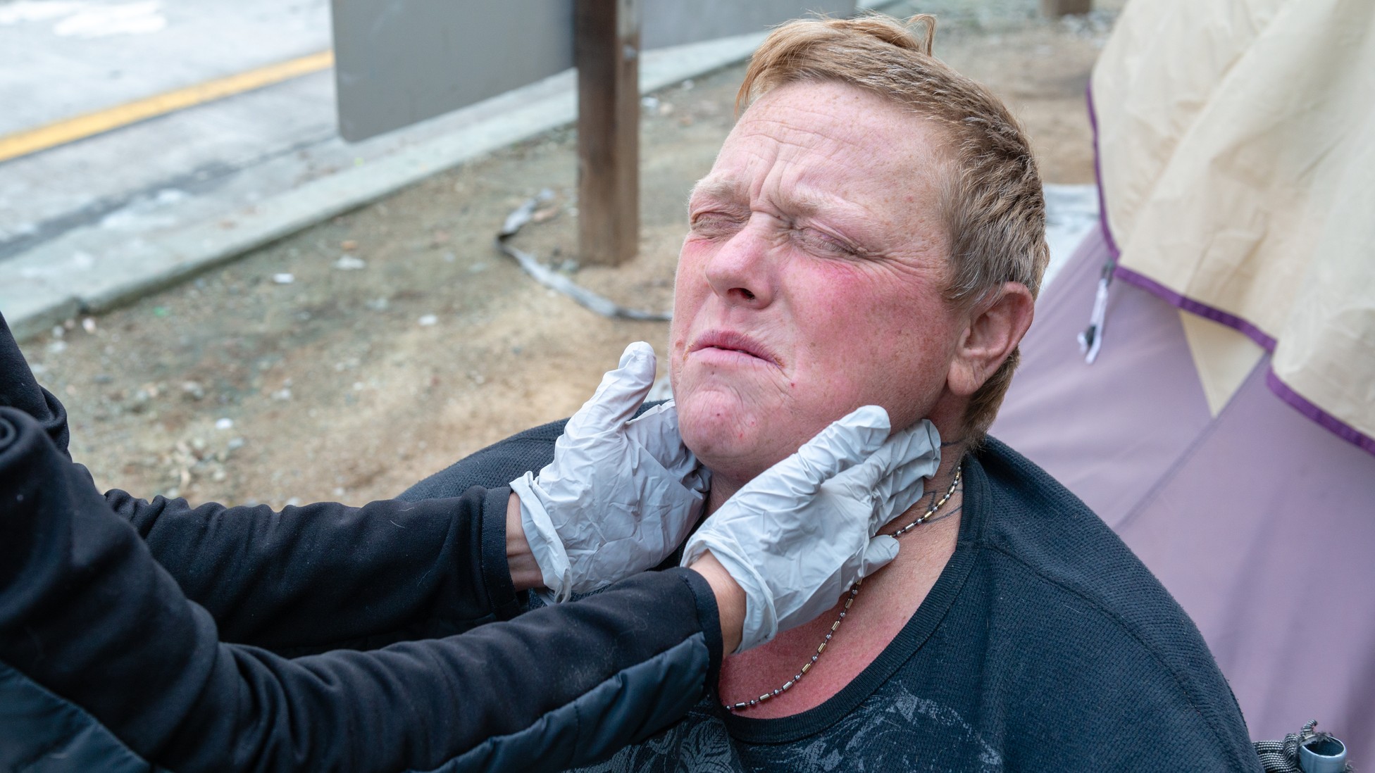 Typhus and Tuberculosis Are Spreading in Homeless Populations - The ...