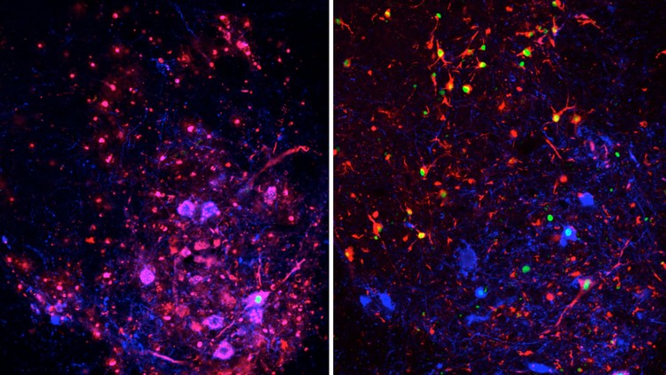 In ALS, a New Understanding of Nerve Inflammation - The Atlantic