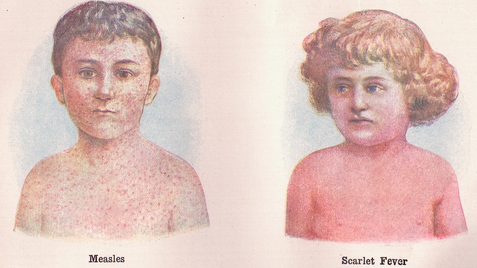 The New Measles - The Atlantic