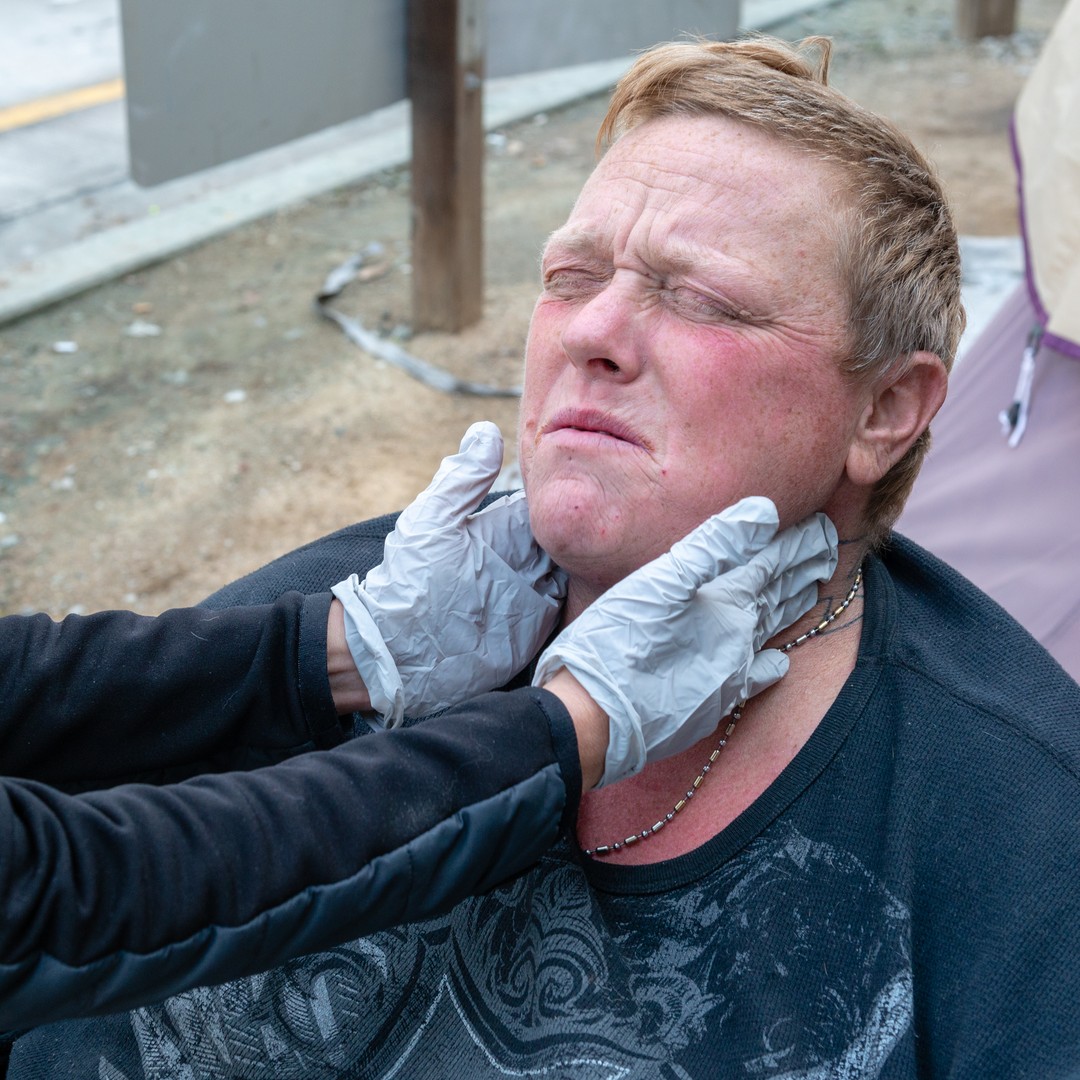 Homeless Guy Face Eaten Off