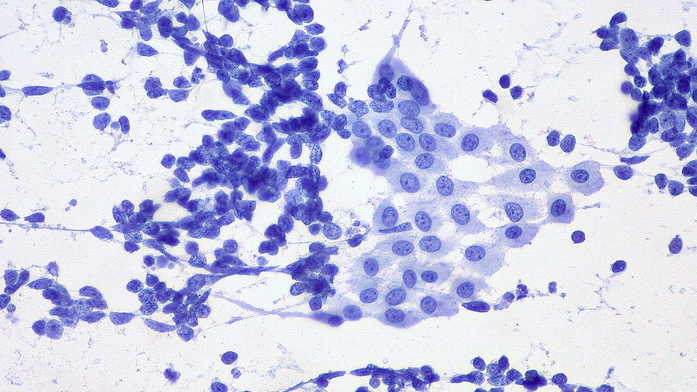 Can Doctors Teach the Body to Cure Cancer? - The Atlantic