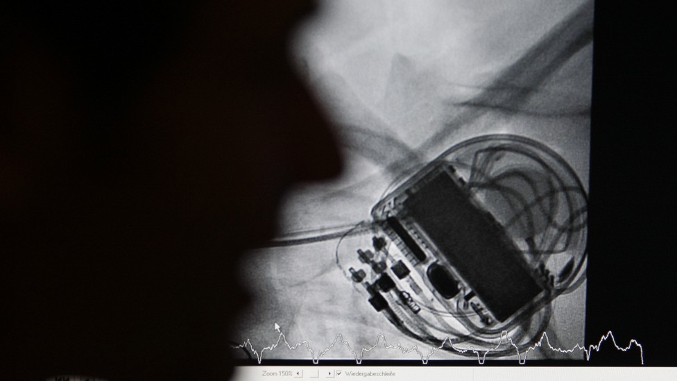 Can Hackers Get Into Your Pacemaker? - The Atlantic