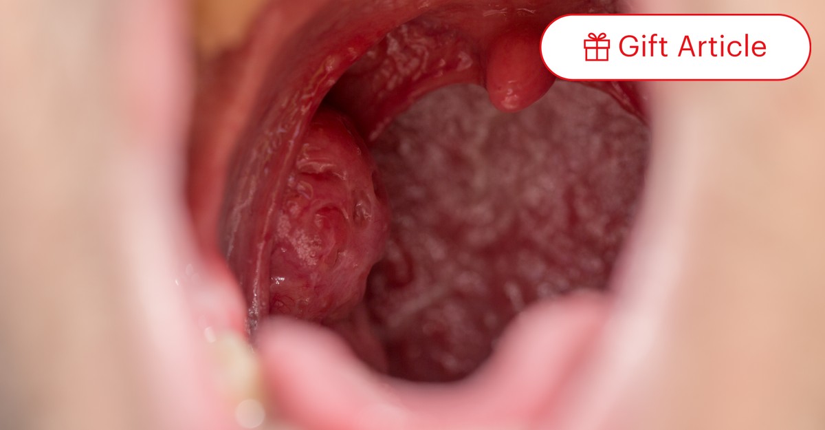 tonsils removed without surgery