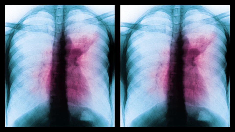 tuberculosis bbc bitesize