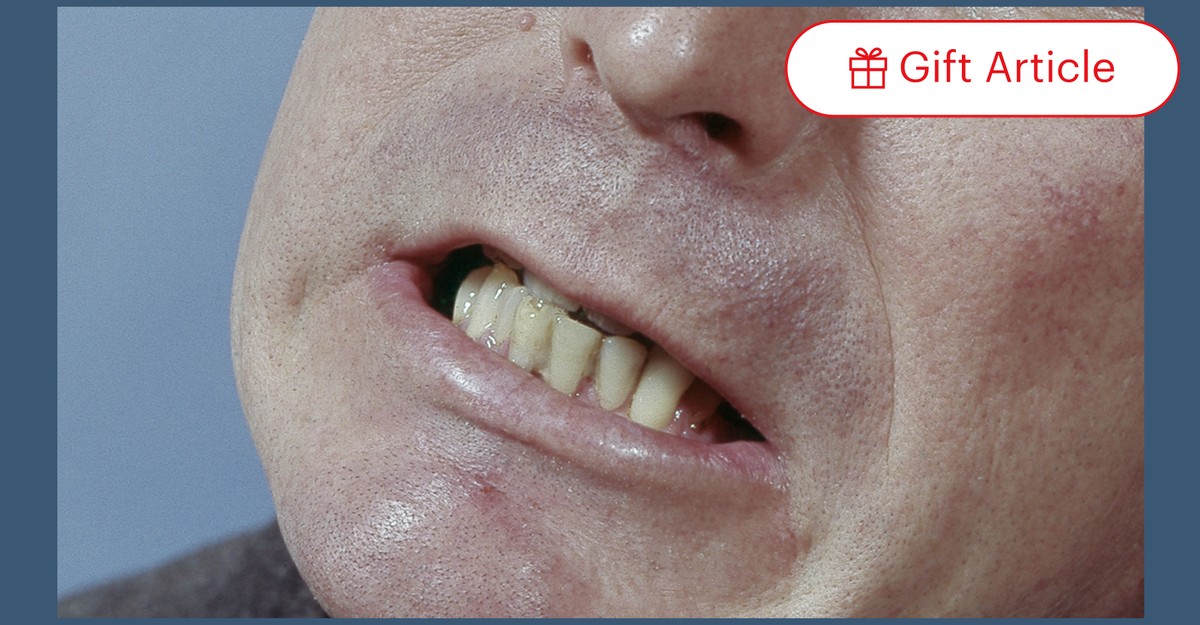 teeth grinder therapy