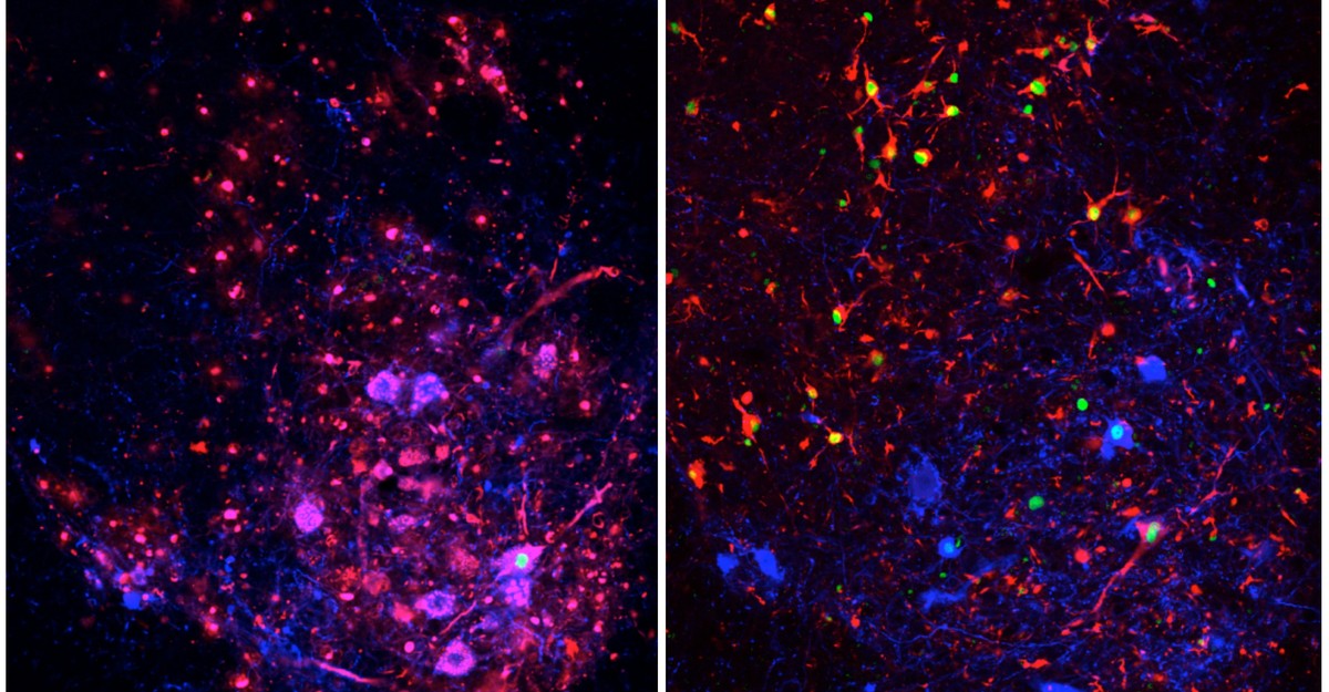 In ALS, a New Understanding of Nerve Inflammation - The Atlantic
